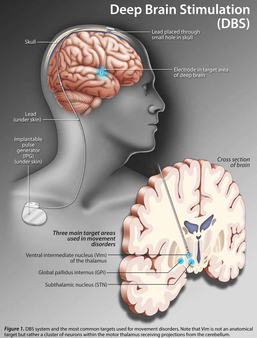 Deep Brain Stimulation HealthPlexus Deep Brain Stimulation HealthPlexus
